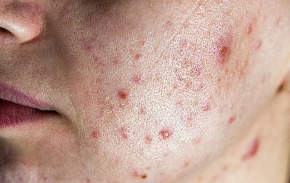 Chronic Skin Condition Blogs | Dermatology Partners