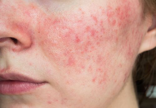Chronic Skin Condition Blogs | Dermatology Partners